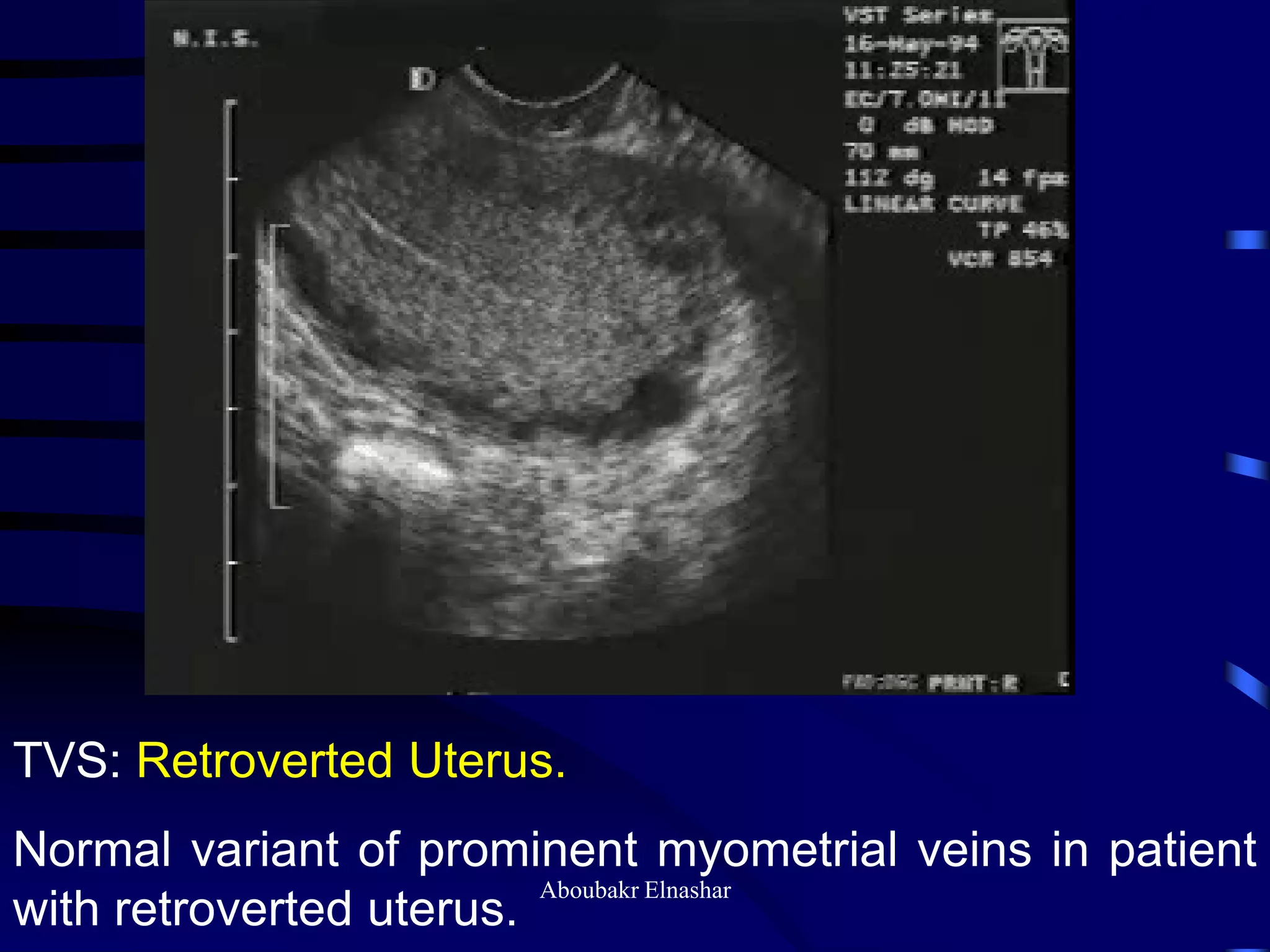 Ultrasonography of the uterus | PDF