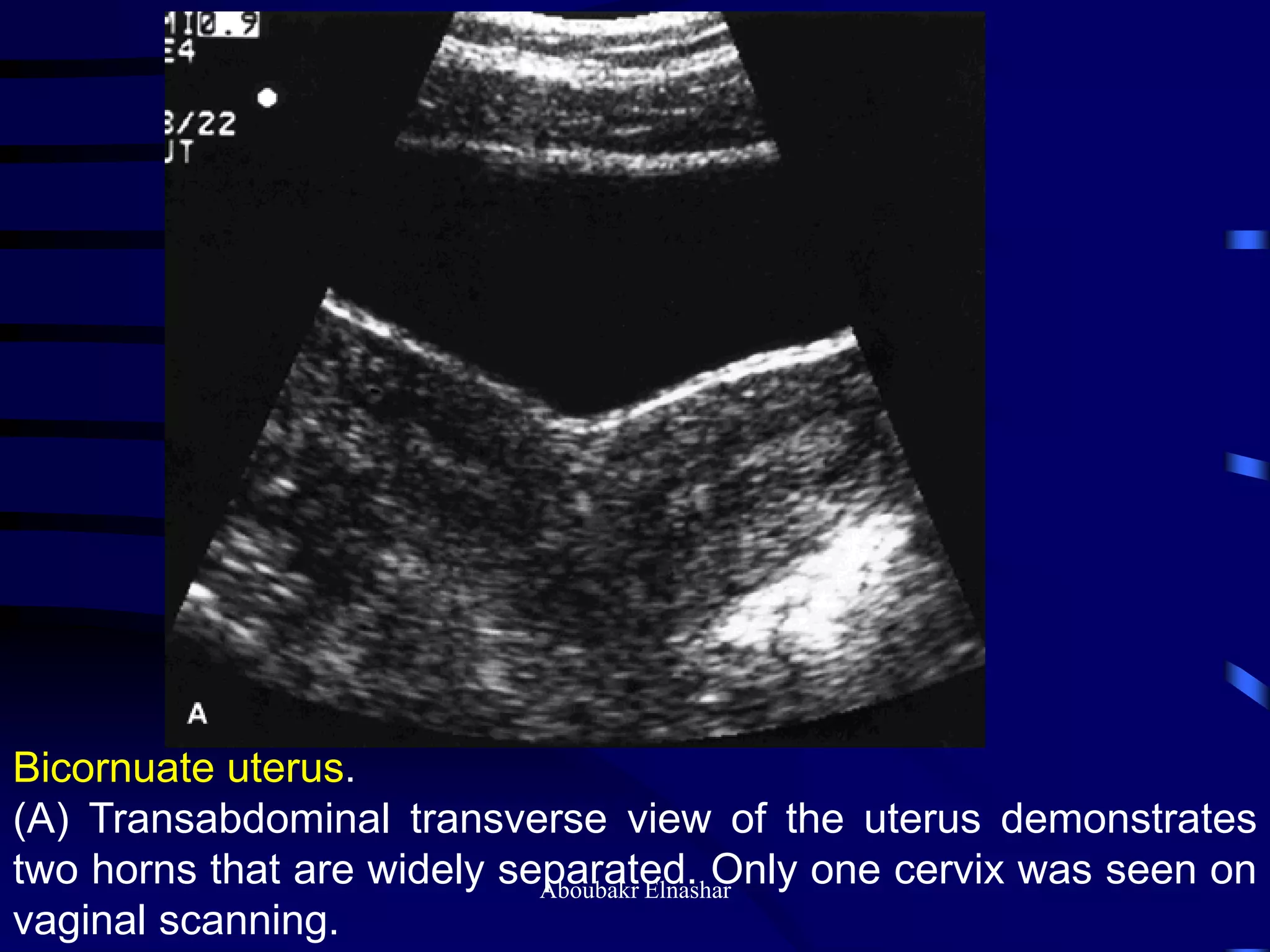 Ultrasonography of the uterus | PDF