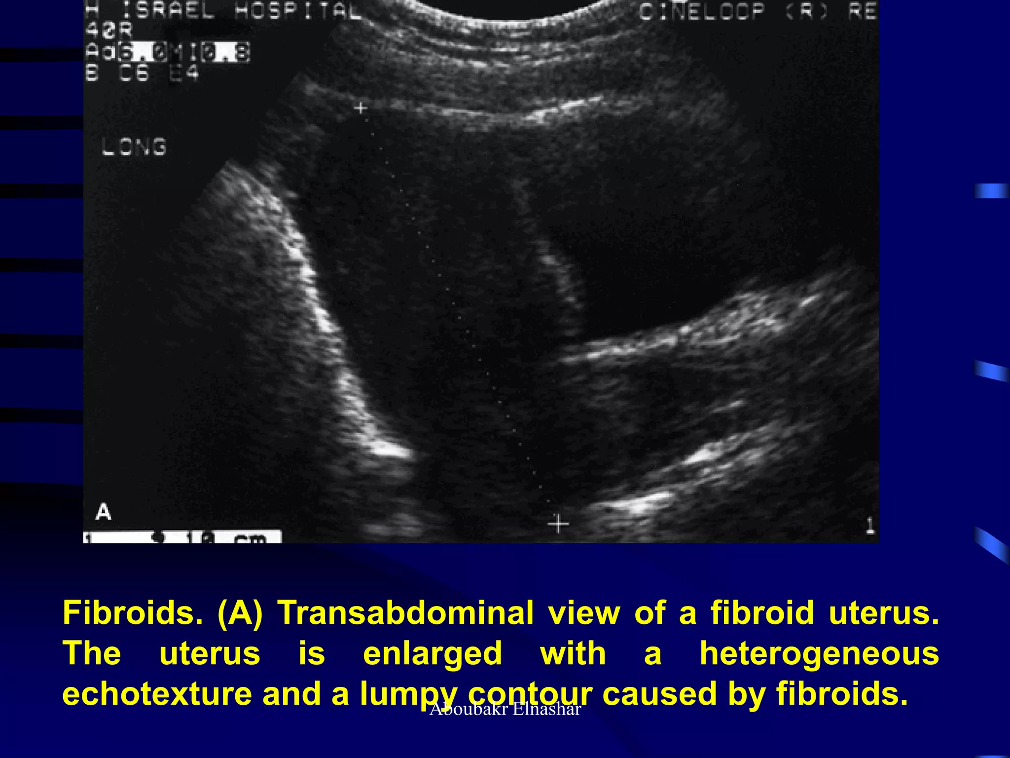 Ultrasonography of the uterus | PDF