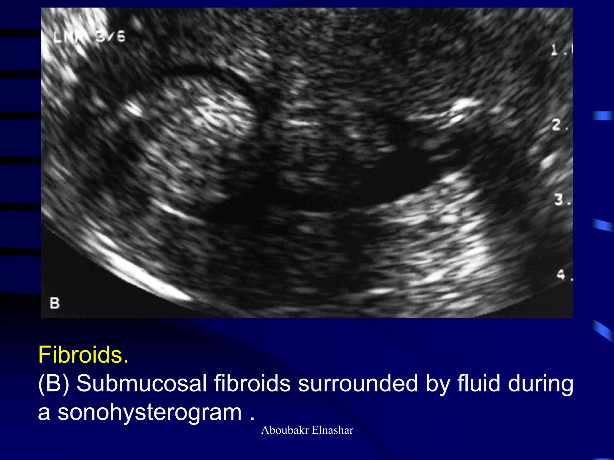 Ultrasonography of the uterus | PDF