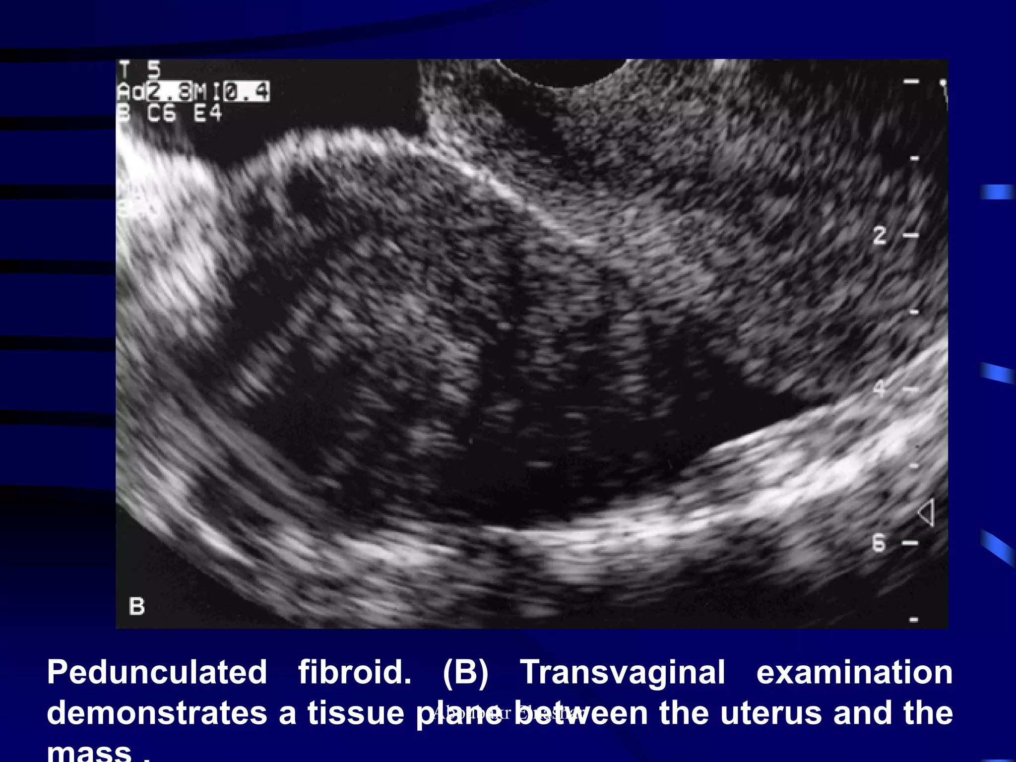 Ultrasonography of the uterus | PDF