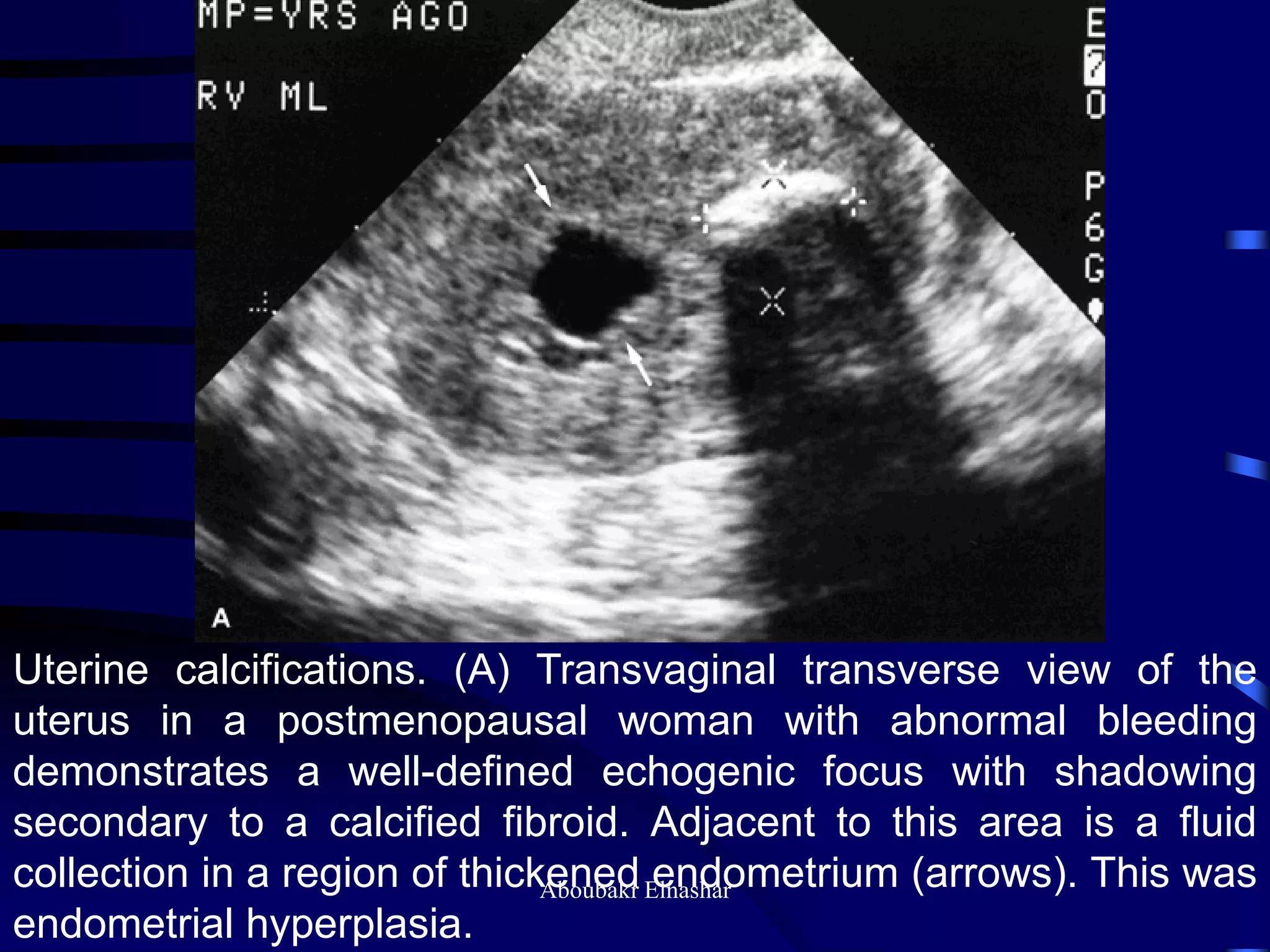 Ultrasonography of the uterus | PDF