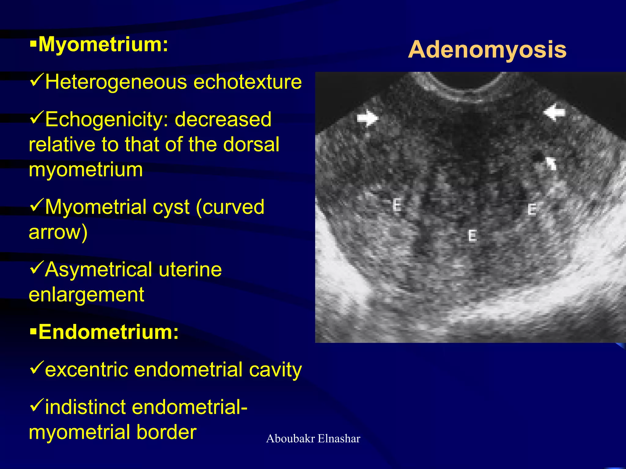 Ultrasonography of the uterus | PDF