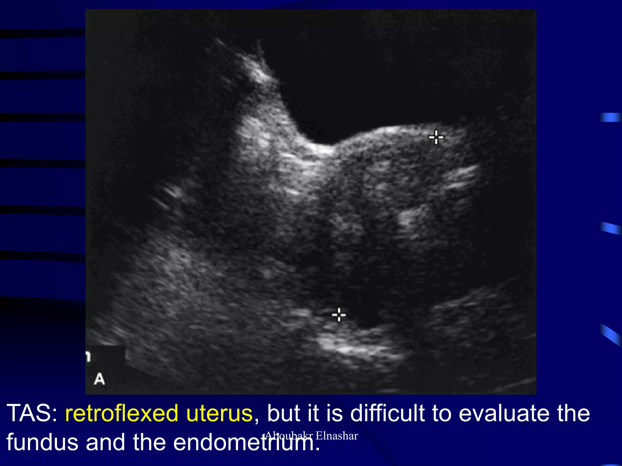 Ultrasonography of the uterus | PDF
