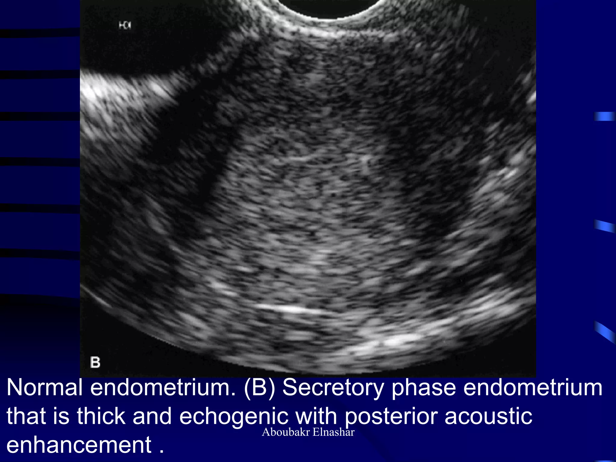 Ultrasonography of the uterus | PDF