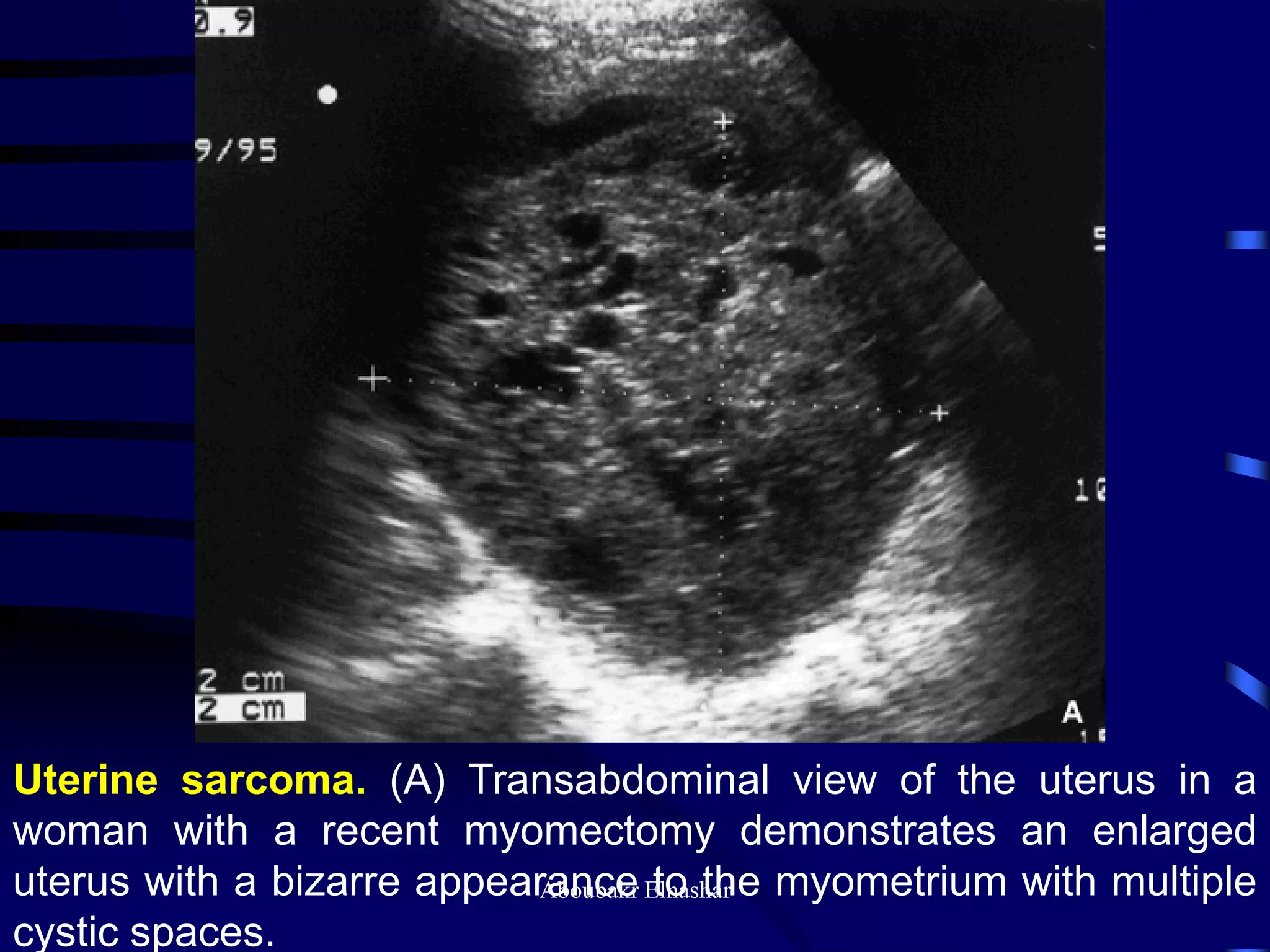 Ultrasonography of the uterus | PDF