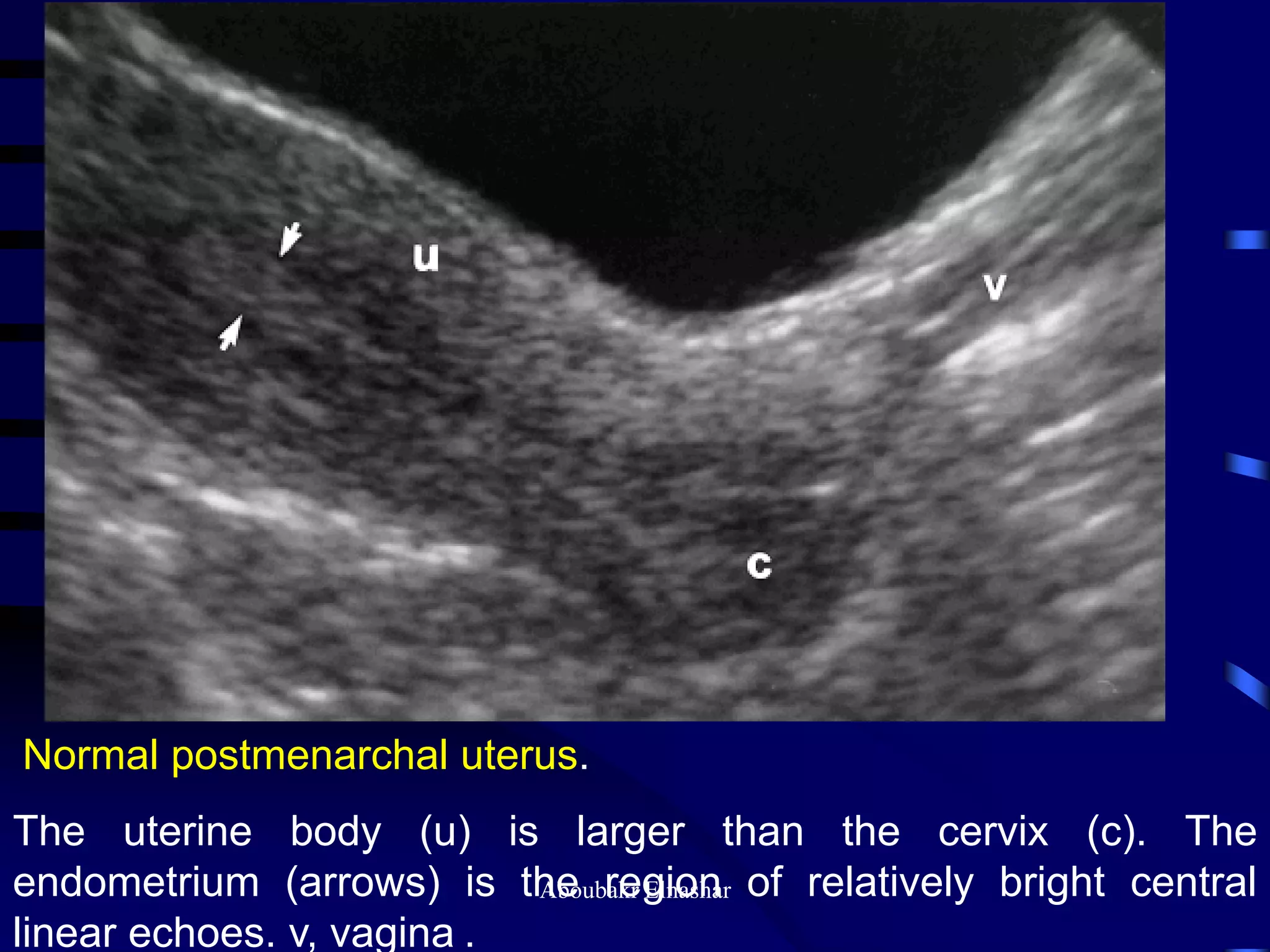 Ultrasonography of the uterus | PDF
