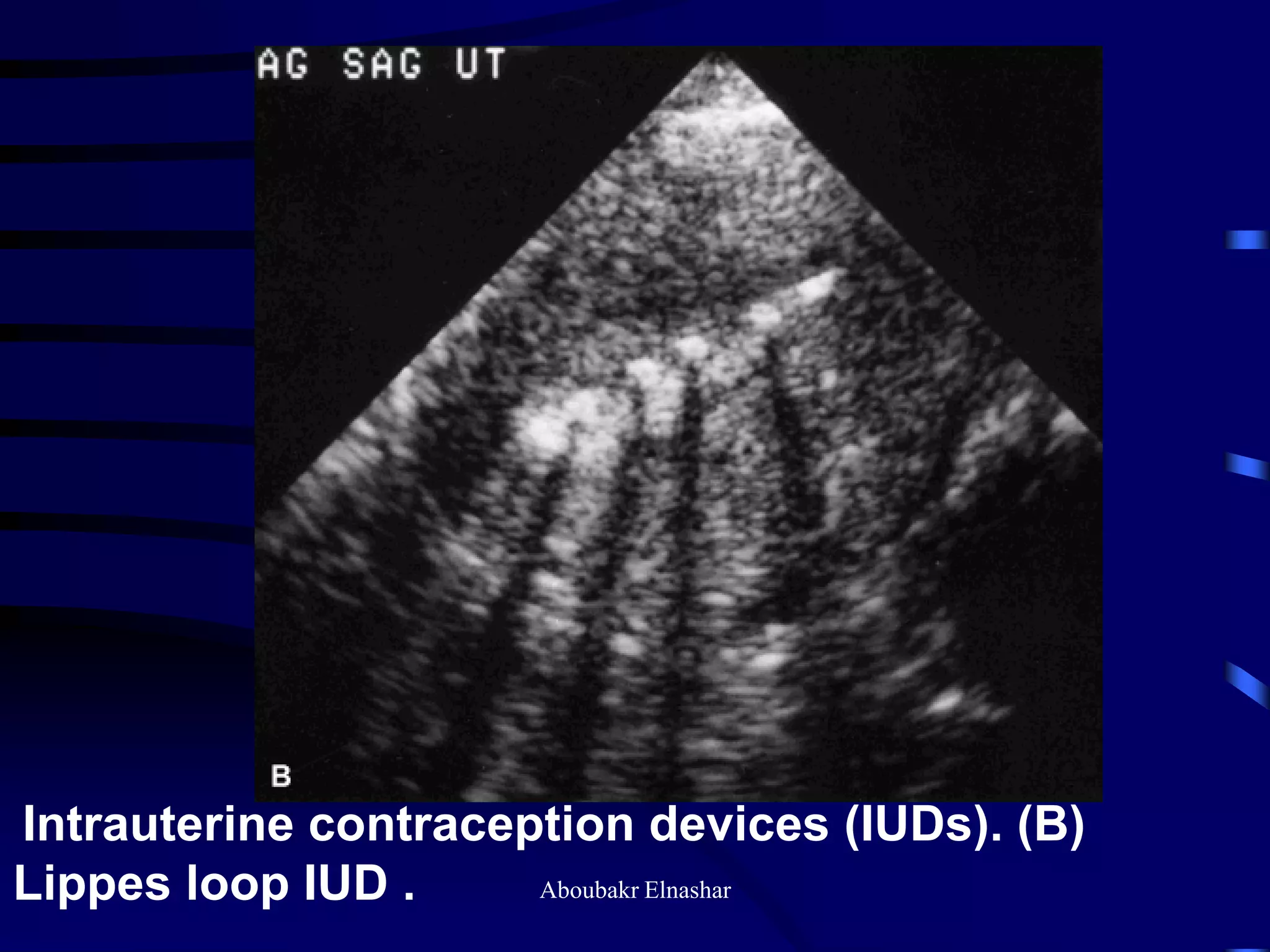 Ultrasonography of the uterus | PDF