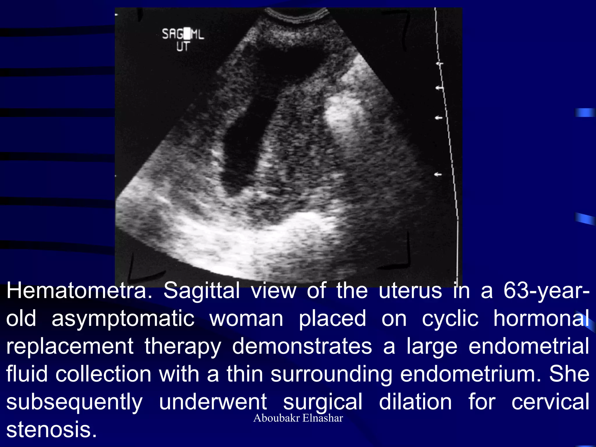 Ultrasonography of the uterus | PDF