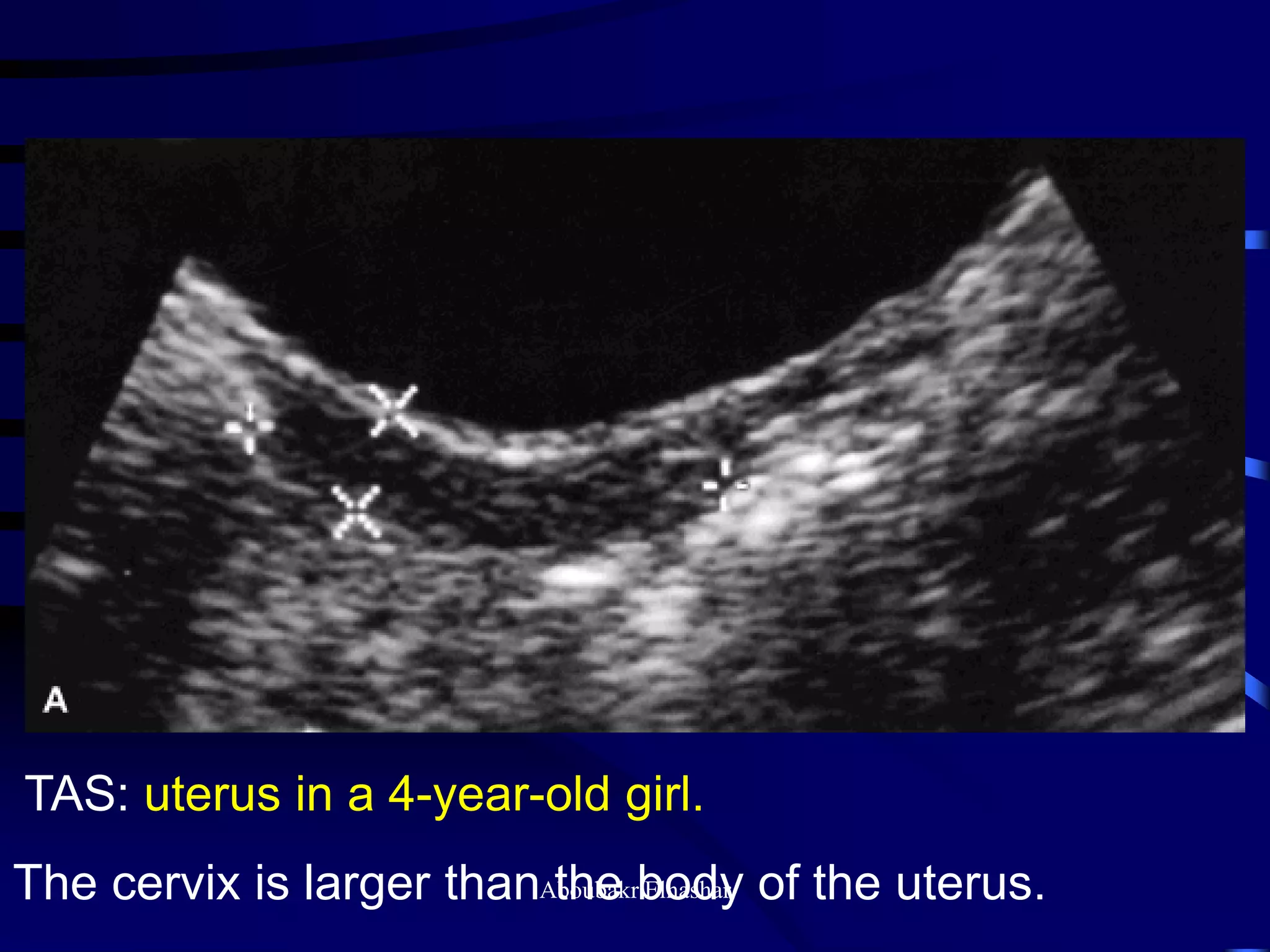 Ultrasonography of the uterus | PDF