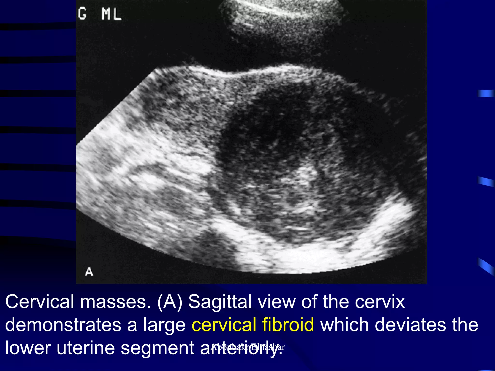 Ultrasonography of the uterus | PDF
