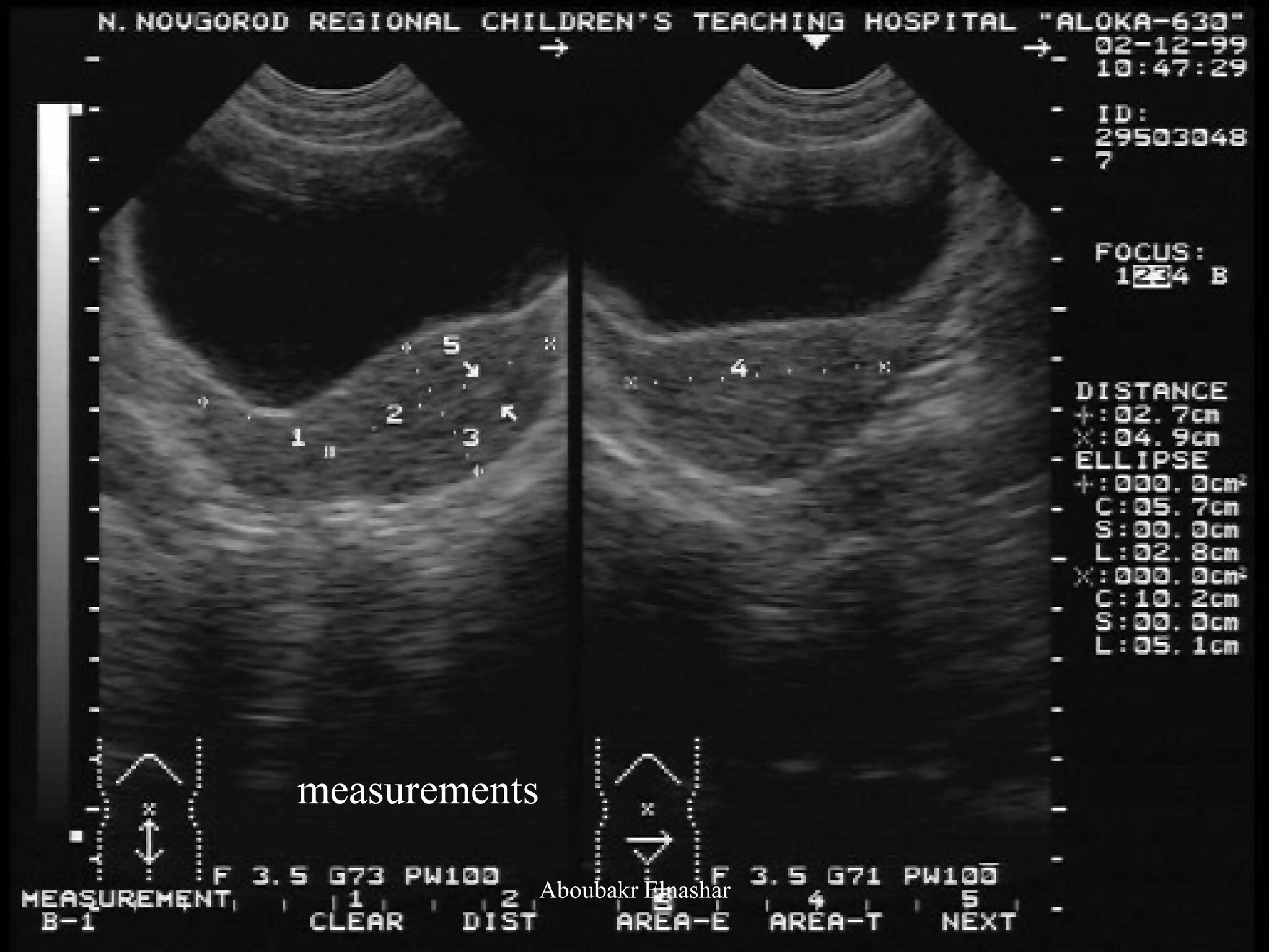 Ultrasonography of the uterus | PDF
