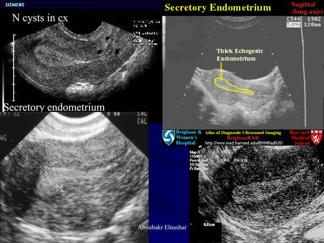 Ultrasonography of the uterus | PDF | Pregnancy | Reproductive Health