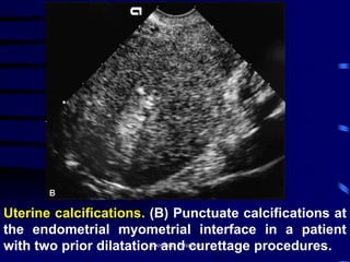 Ultrasonography of the uterus | PDF