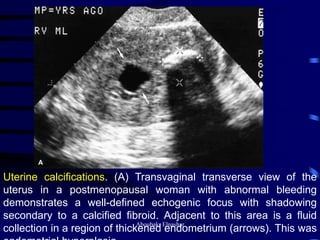 Ultrasonography of the uterus | PDF