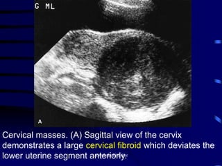 Ultrasonography of the uterus | PDF