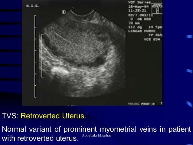 Ultrasonography of the uterus