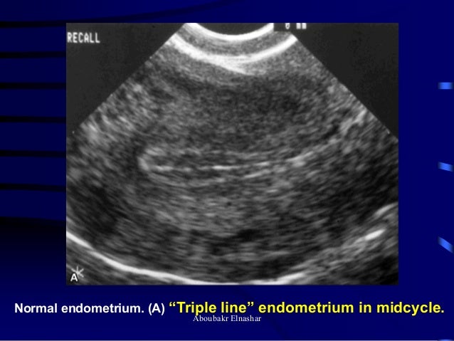 Ultrasonography of the uterus