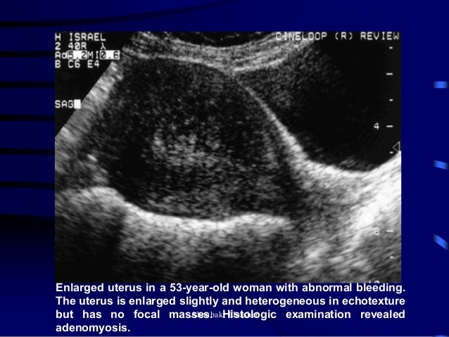 Ultrasonography Of The Uterus
