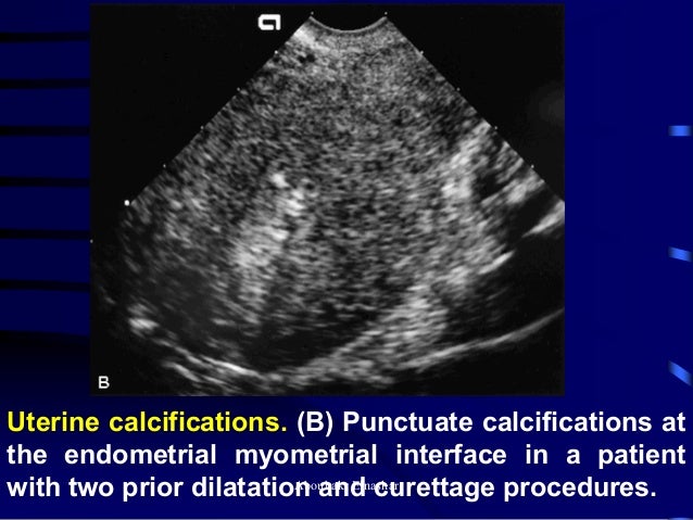 Ultrasonography of the uterus