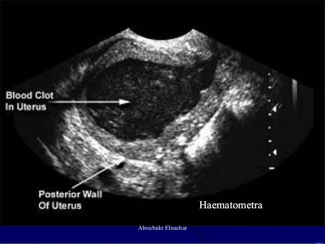 Blood Clot Uterine Lining