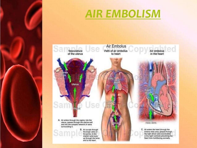Embolism | PPTX | Lung and Respiratory Health | Diseases and Conditions