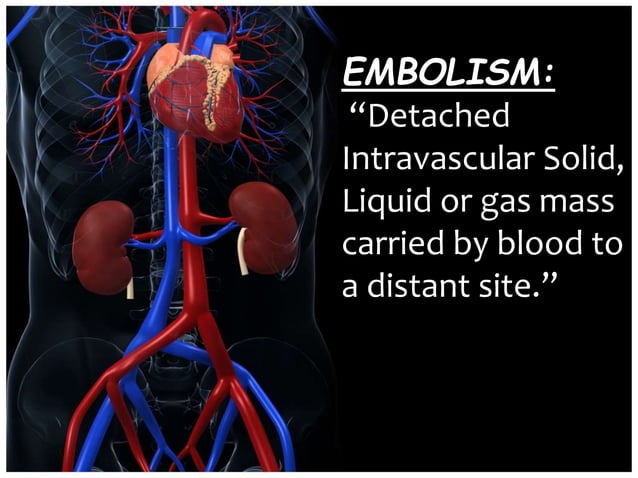 Embolism | PPTX | Lung and Respiratory Health | Diseases and Conditions