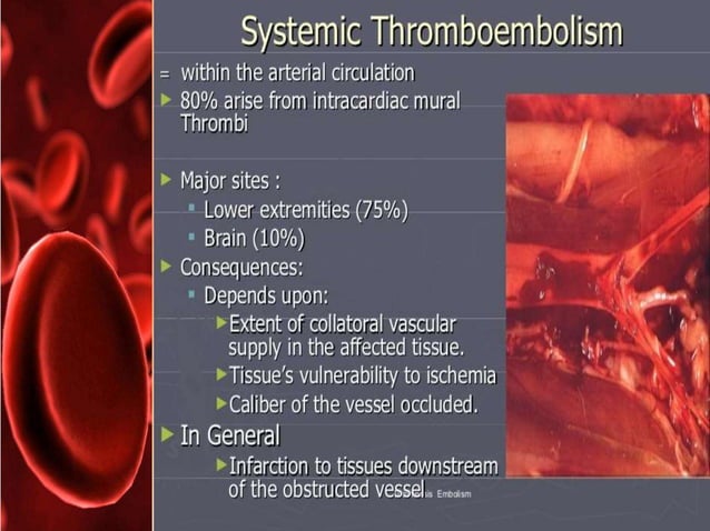Embolism | PPTX | Lung and Respiratory Health | Diseases and Conditions