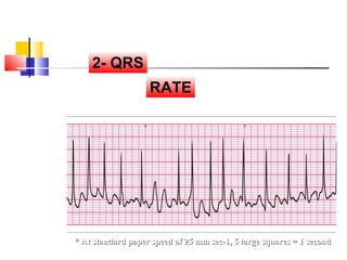 ECG Interpretation by USAMA ELSAYED | PPT