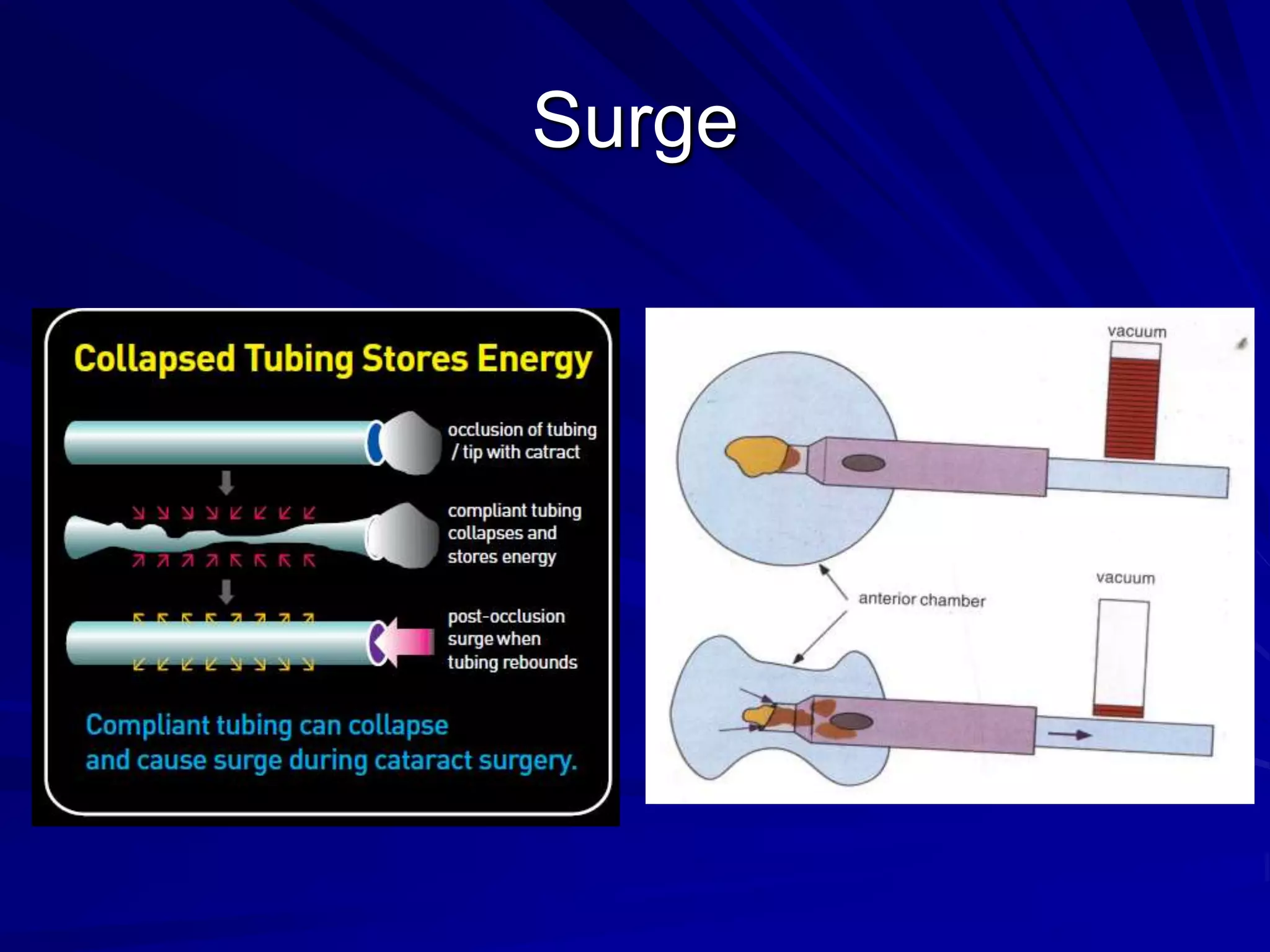 Phaco basics and beyond | PPTX