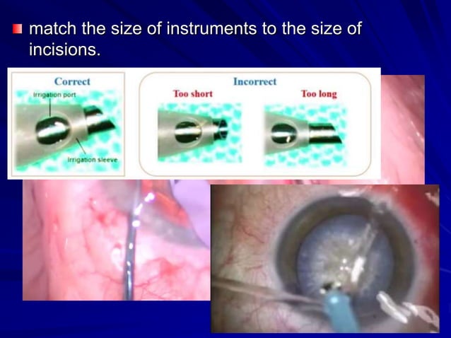Phaco basics and beyond | PPTX | Eye and Vision Conditions | Diseases ...