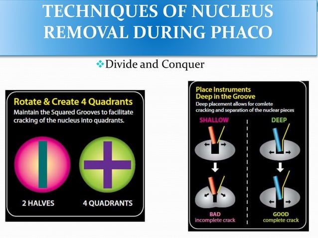 Phaco basics and beyond | PPTX | Eye and Vision Conditions | Diseases ...