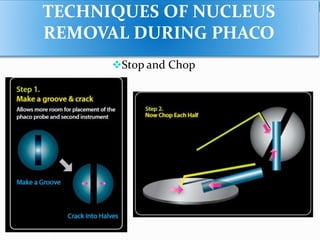 Phaco basics and beyond | PPTX