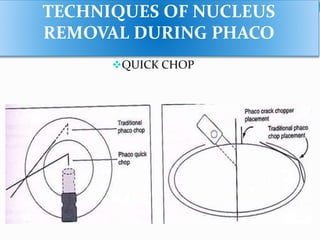 Phaco basics and beyond | PPTX