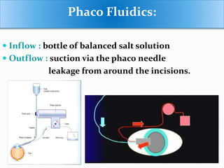 Phaco basics and beyond | PPTX