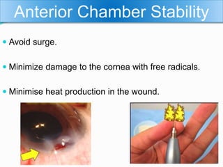 Phaco basics and beyond | PPTX