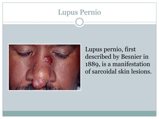 Lupus Pernio Histology