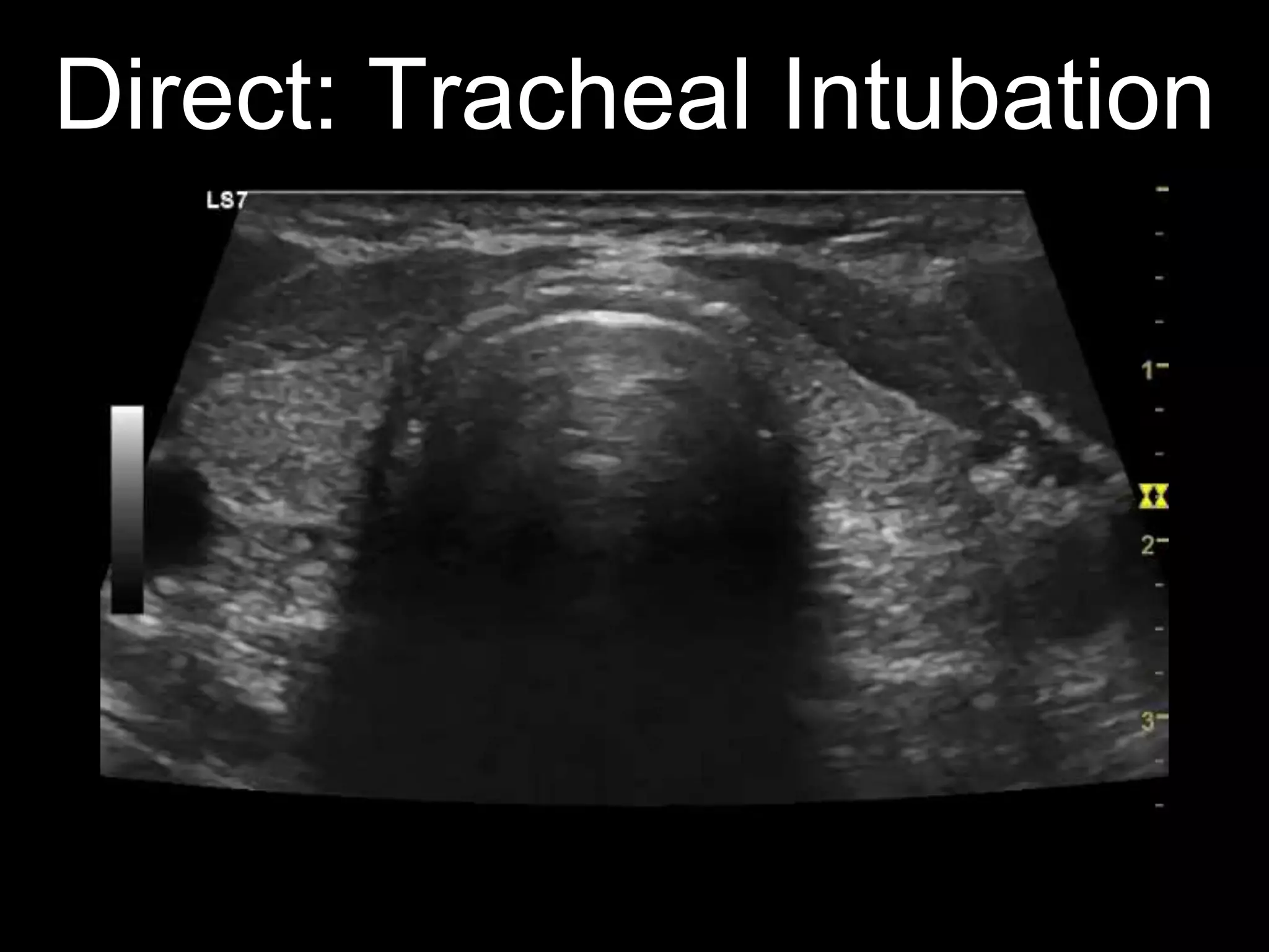 Ultrasound confirmation of endotracheal tube placement | PPTX