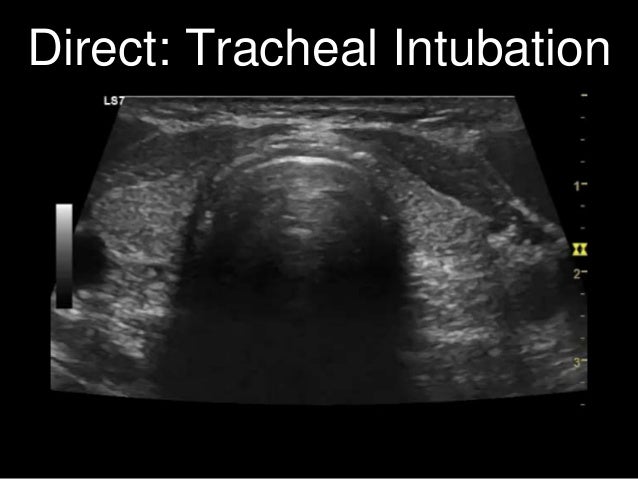 Ultrasound confirmation of endotracheal tube placement