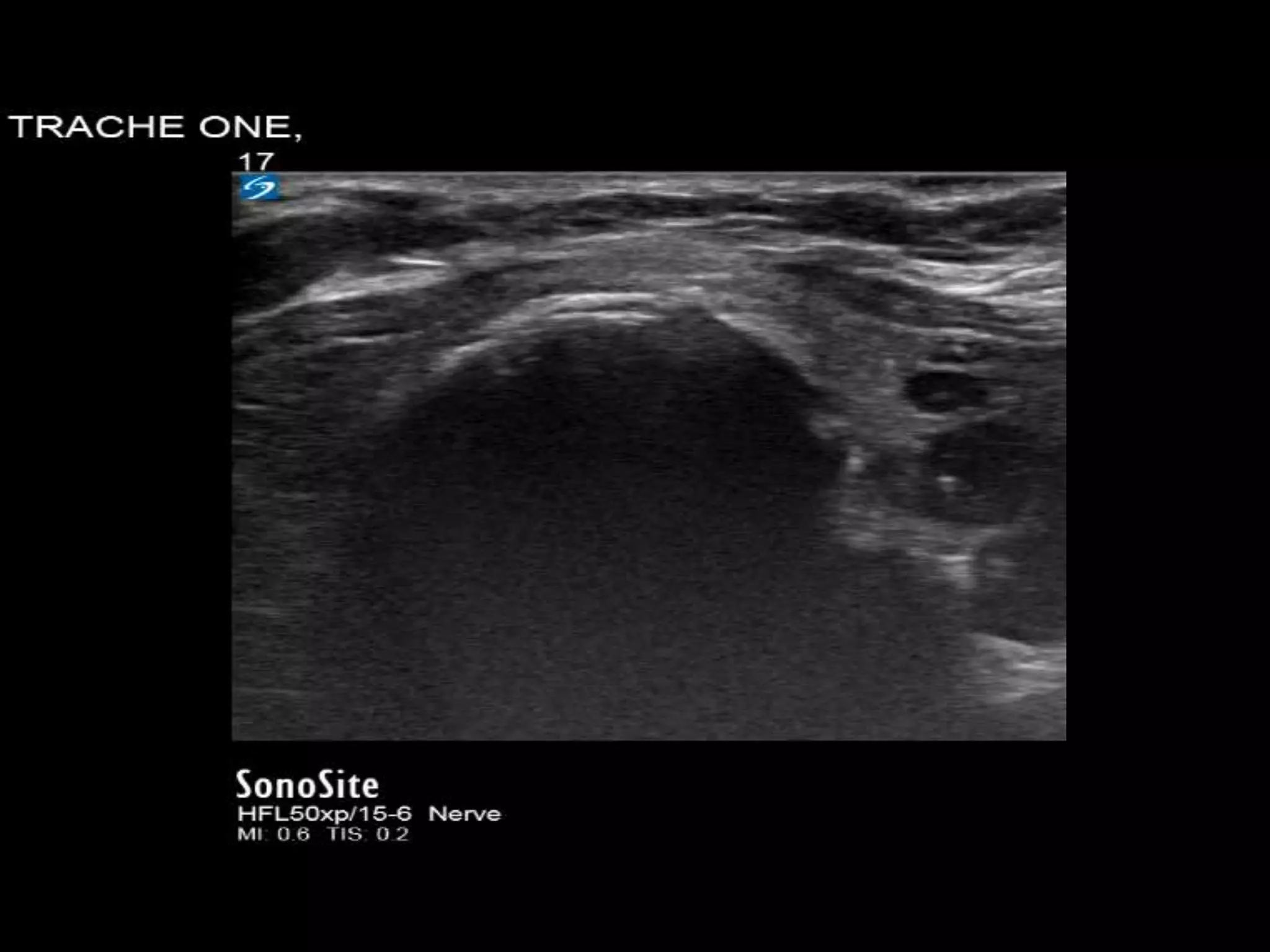 Ultrasound confirmation of ETT placement | PPT