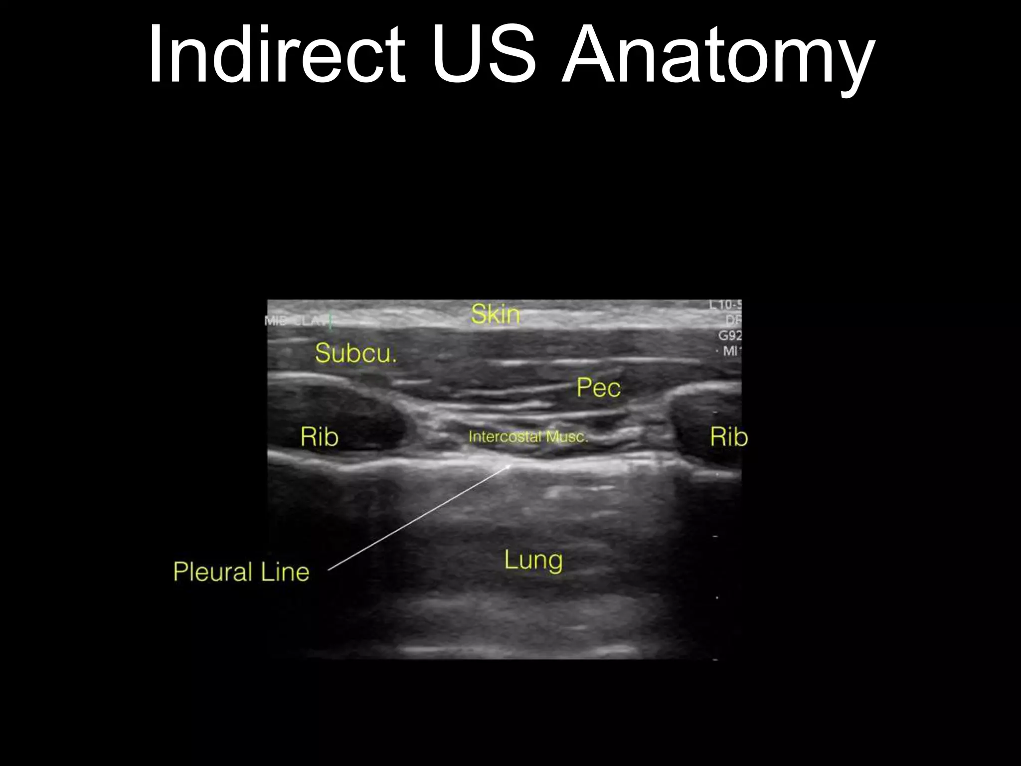 Ultrasound confirmation of ETT placement | PPT