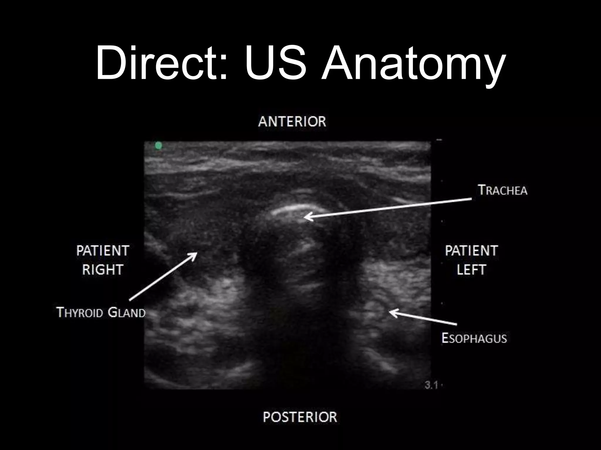 Ultrasound confirmation of ETT placement | PPT