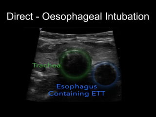 Ultrasound confirmation of ETT placement | PPT
