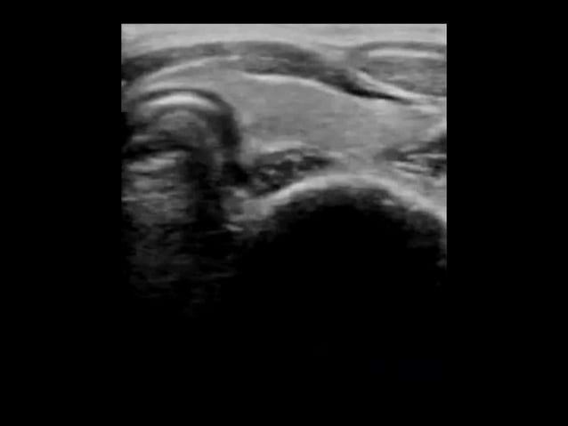 Ultrasound confirmation of ETT placement | PPT