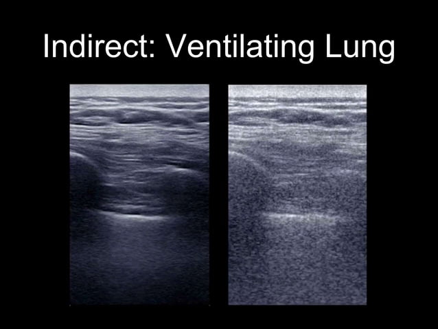 Ultrasound confirmation of ETT placement | PPT