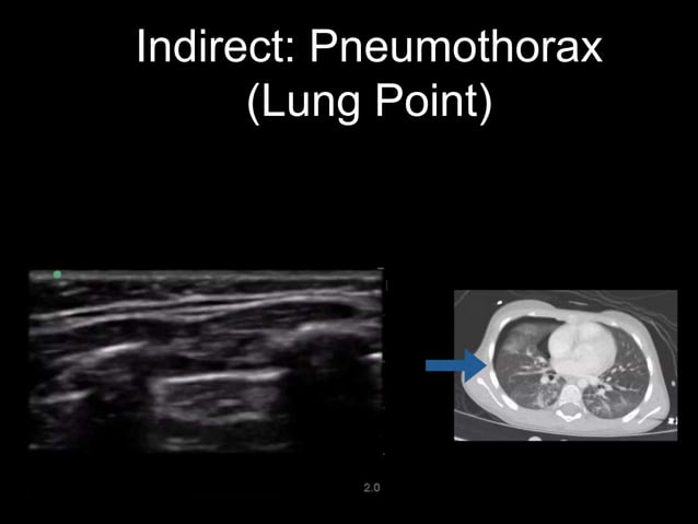 Ultrasound confirmation of ETT placement | PPT