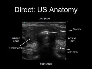 Ultrasound confirmation of ETT placement | PPT