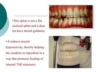 Use and abuse of bite splint. | PPT