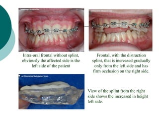 Use and abuse of bite splint. | PPT