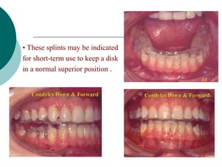 Use and abuse of bite splint. | PPT
